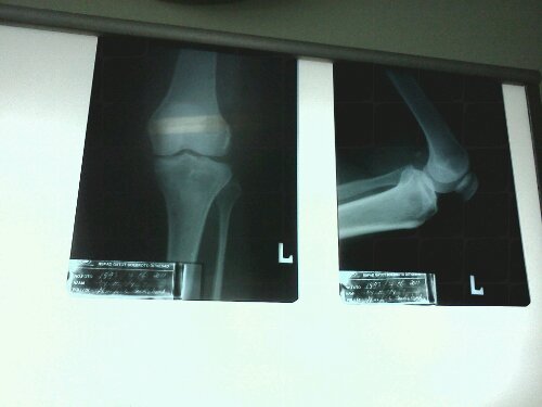 Rontgen Lutut Kiri | Eviindrawanto.Com